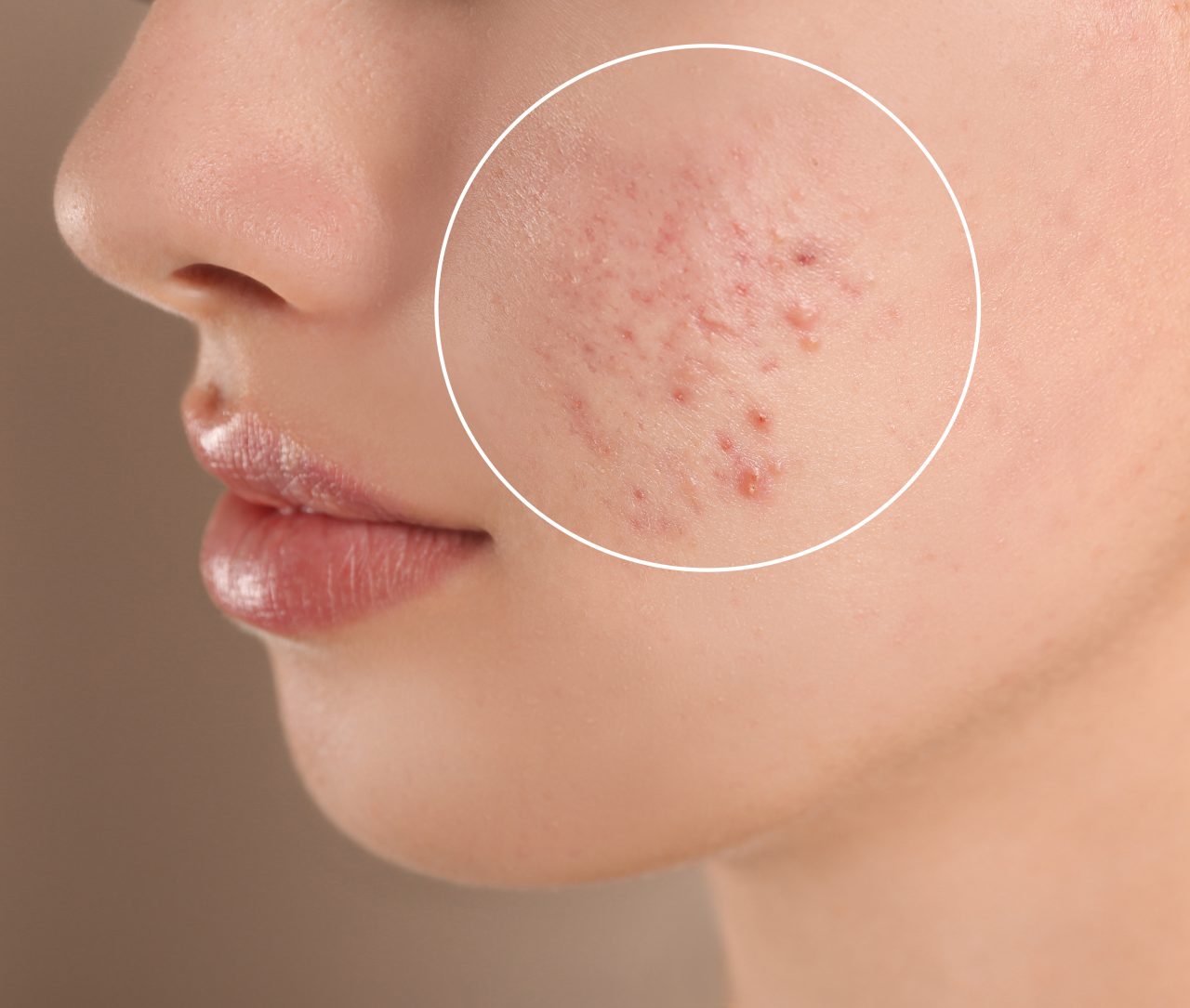 Decoding Acne: Unveiling Types and Treatments for Holistic HEALTH AND ...